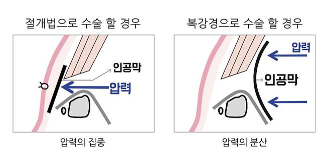 복강경 탈장 수술 회복 빠르고 통증 적게 할 수 있다 Daum