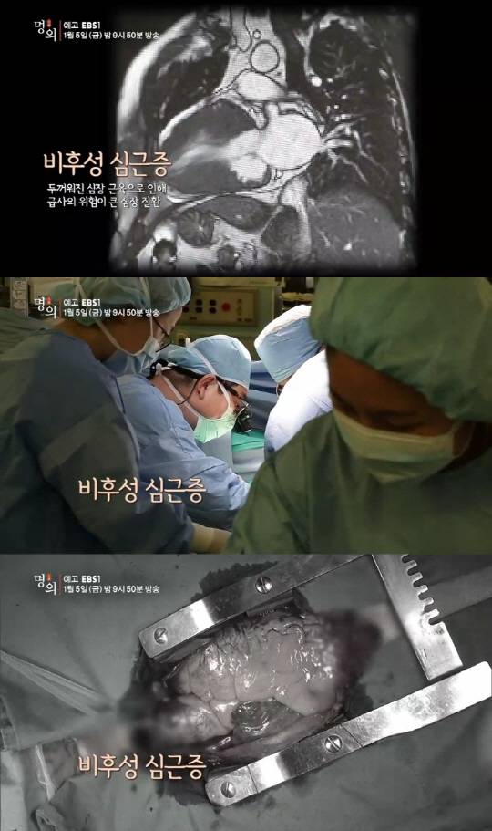 명의 돌연사 부르는 비후성 심근증 증상과 진단 치료법 소개