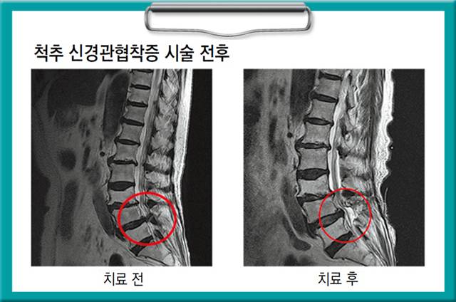 엉치뼈 시큰거리고 팔다리 저림 내시경 치료로 잡는다