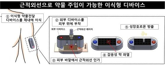 주사 바늘 없이 빛으로 약물 투여하는 생체이식 장치 나왔다