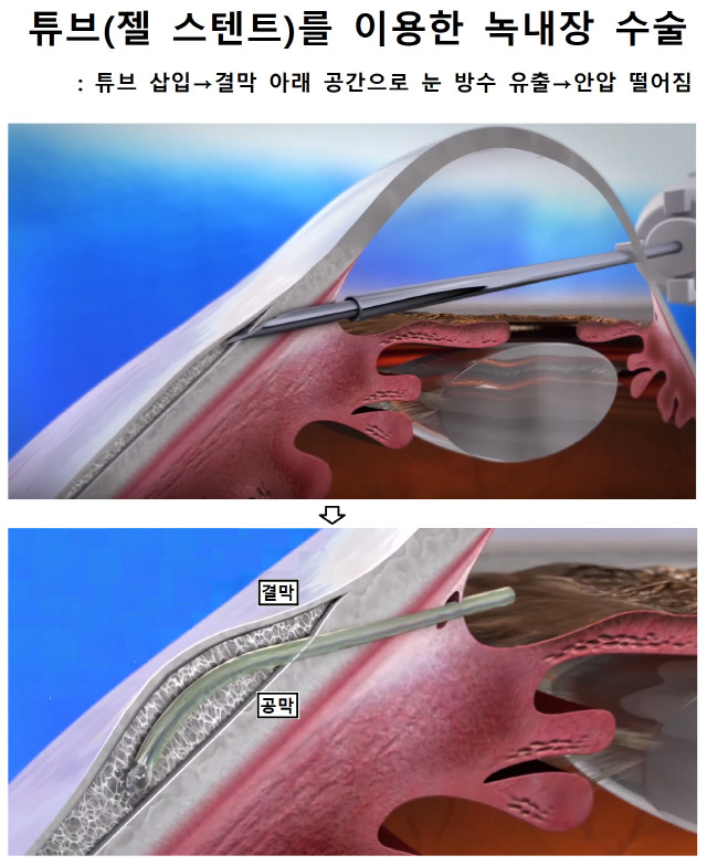 녹내장 치료 젤 스텐트 삽입 신기술 뜬다