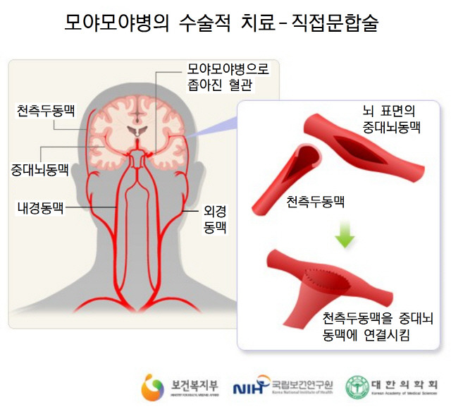 모야모야병 뇌혈관 좁아져 뇌졸중 초래환자 22가 20대 이하