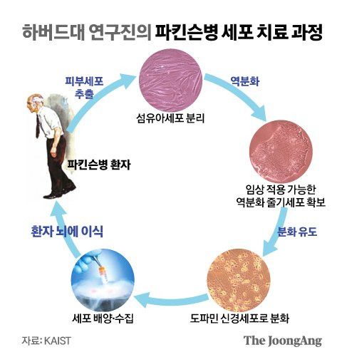죽어가던 사람이 뛴다 줄기세포로 치료하는 파킨슨병