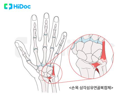 탁구 치고 손목과 발목이 아프다면 스포츠 부상주의보