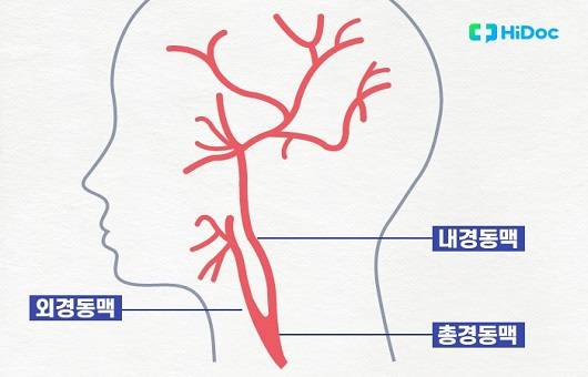 목 혈관이 좁아지면 나타나는 증상경동맥 협착증이란