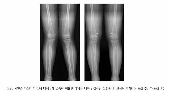 10세 이하 소아 환자 오다리 엑스자 다리 수술 받으면 재발 위험 높아져