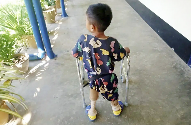 지뢰에 다리 잃은 3살 아이‘인간 방패 쓰는 잔혹한 미얀마 군인들