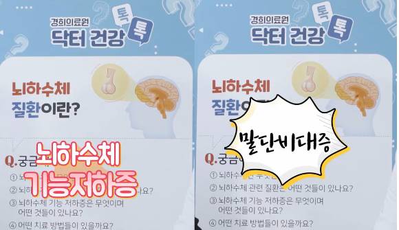 주말엔 건강 뇌하수체 호르몬 분비 불균형말단비대증 등 불러온다