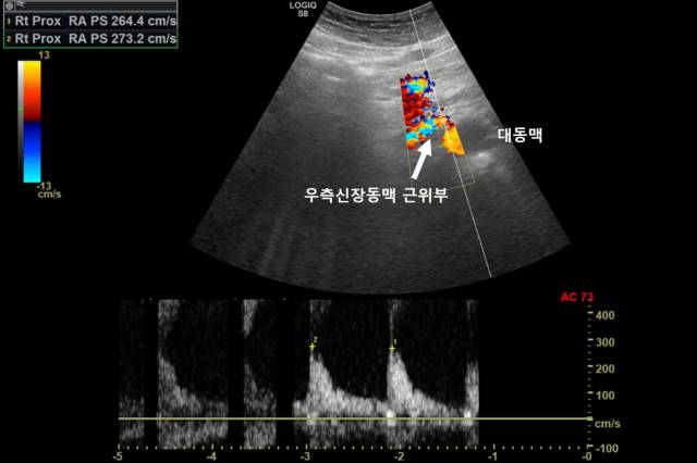 고혈압 약발 안 받는 이유 이것 때문일수도 건강 팁