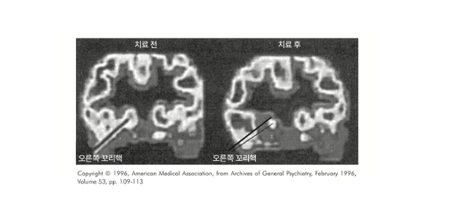 음료수 열 맞추고 손 계속 씻고 현대인의 강박 장애를 고치는 4단계