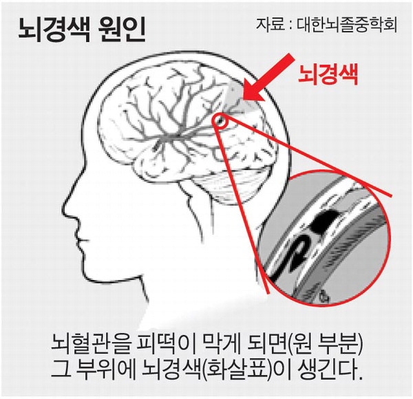 사망 원인 1위 뇌졸중체중관리와 저염식으로 예방을