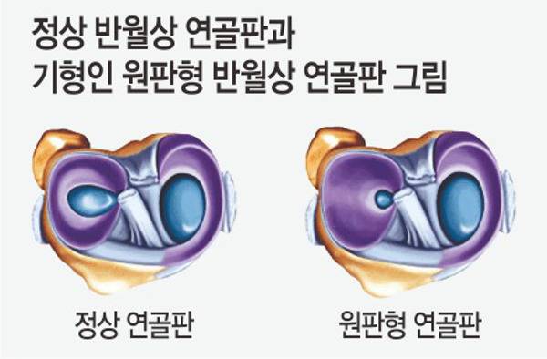 악 내 무릎” ‘반월상 연골판 파열 환자 3년간 평균 17만명 육박
