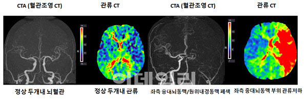 뇌 Ct·mri 무슨 차이일까 뇌졸중 극복하기