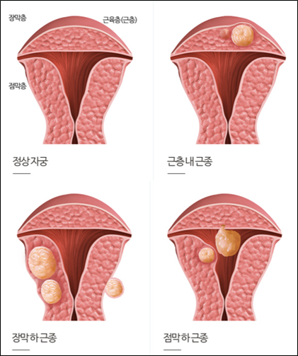 점막하근종 크기 작아도 로봇수술 등 치료 필요할 수 있어