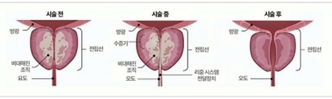 여자는 모르는 전립선비대증 이것이 해법 될까