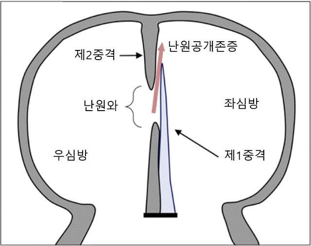 출생 후 닫혀야 하는 ‘난원공 열려 있으면 자칫 뇌졸중 위험”