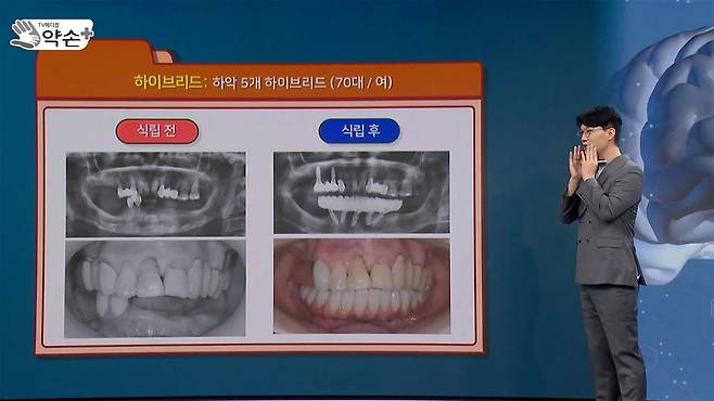 약손 다수의 치아상실 재건 전악보철 ⑮하이브리드의 특징