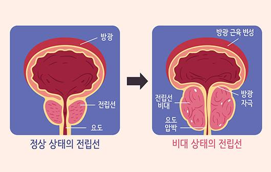 전립선비대증의 근본적 치료 ‘리줌시술부작용 걱정 없이 간편하게