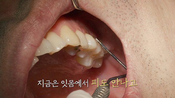 그냥 놔두면 뽑아야 해요 잇몸병 막는 방법은 귀하신 몸