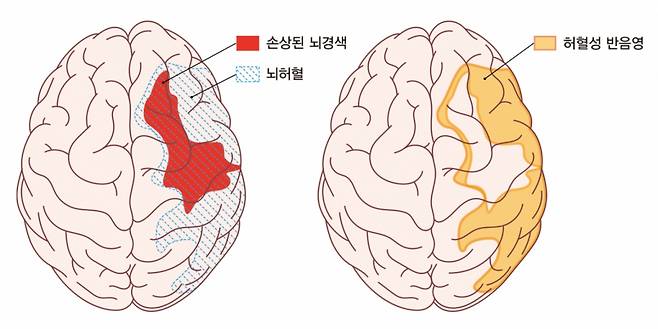 갑자기 발음 어눌해지고 걸음 휘청뇌혈관 골든타임 270분