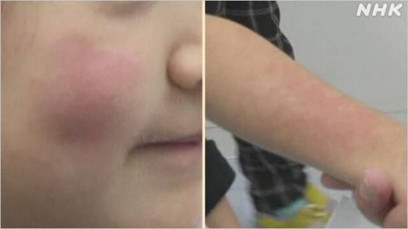 감염시 유산위험” 4년만에 유행하는 ‘사과병 뭐길래옆나라는 비상 걸렸다