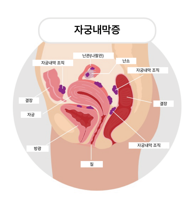극심한 생리통 참기만 했다그게 이것 때문이라면