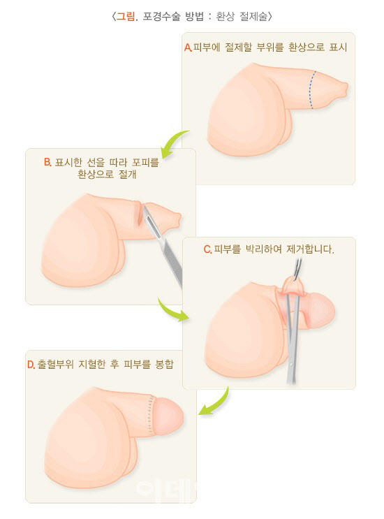 포경수술 필요한가요 안치영의 메디컬와치